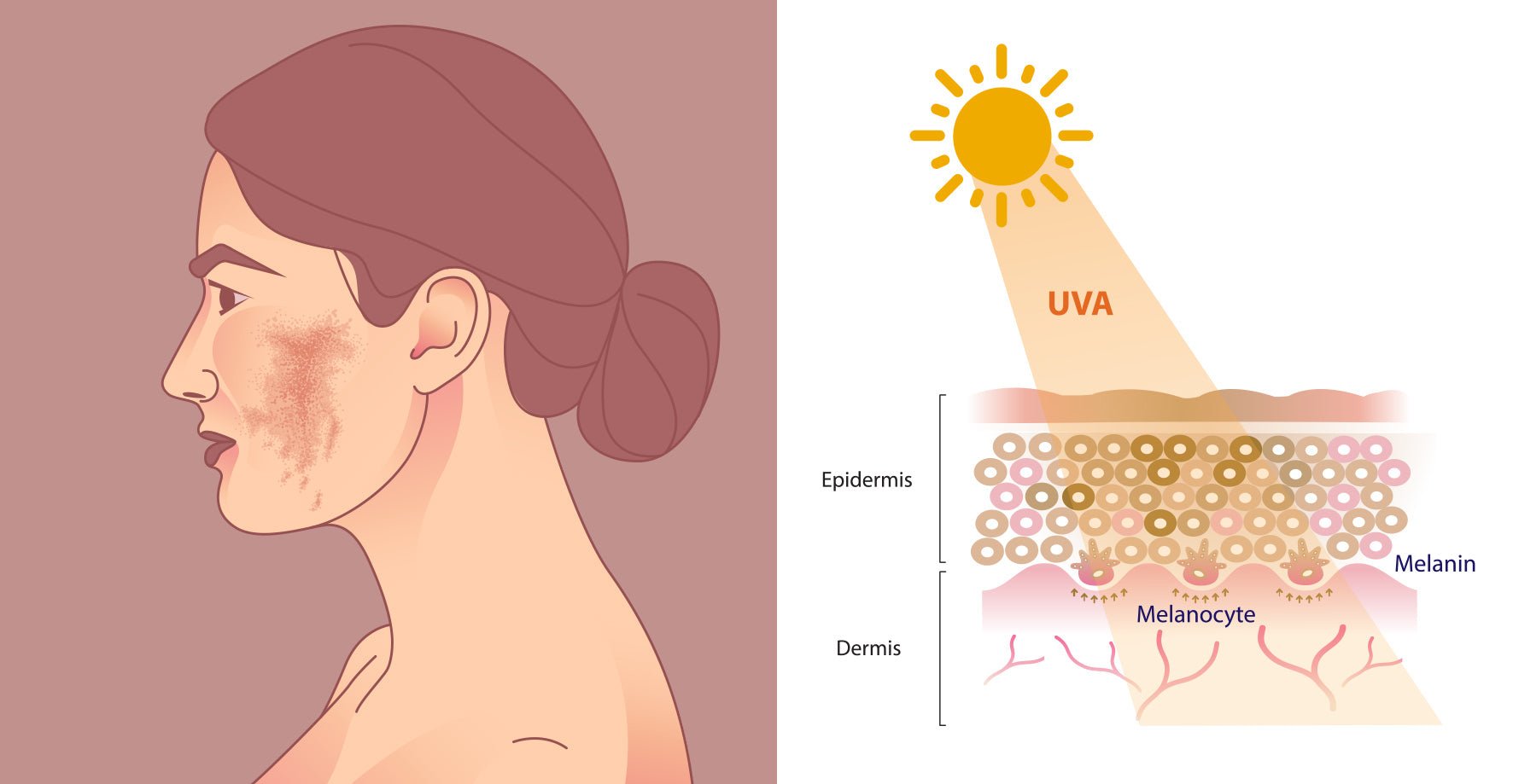 Hyperpigmentation – Hyaluxe Body